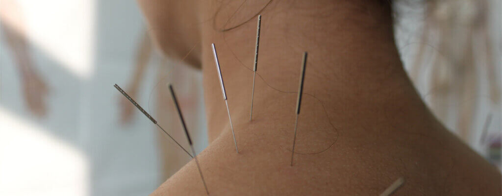 Acupuncture | Ottawa Health Group
